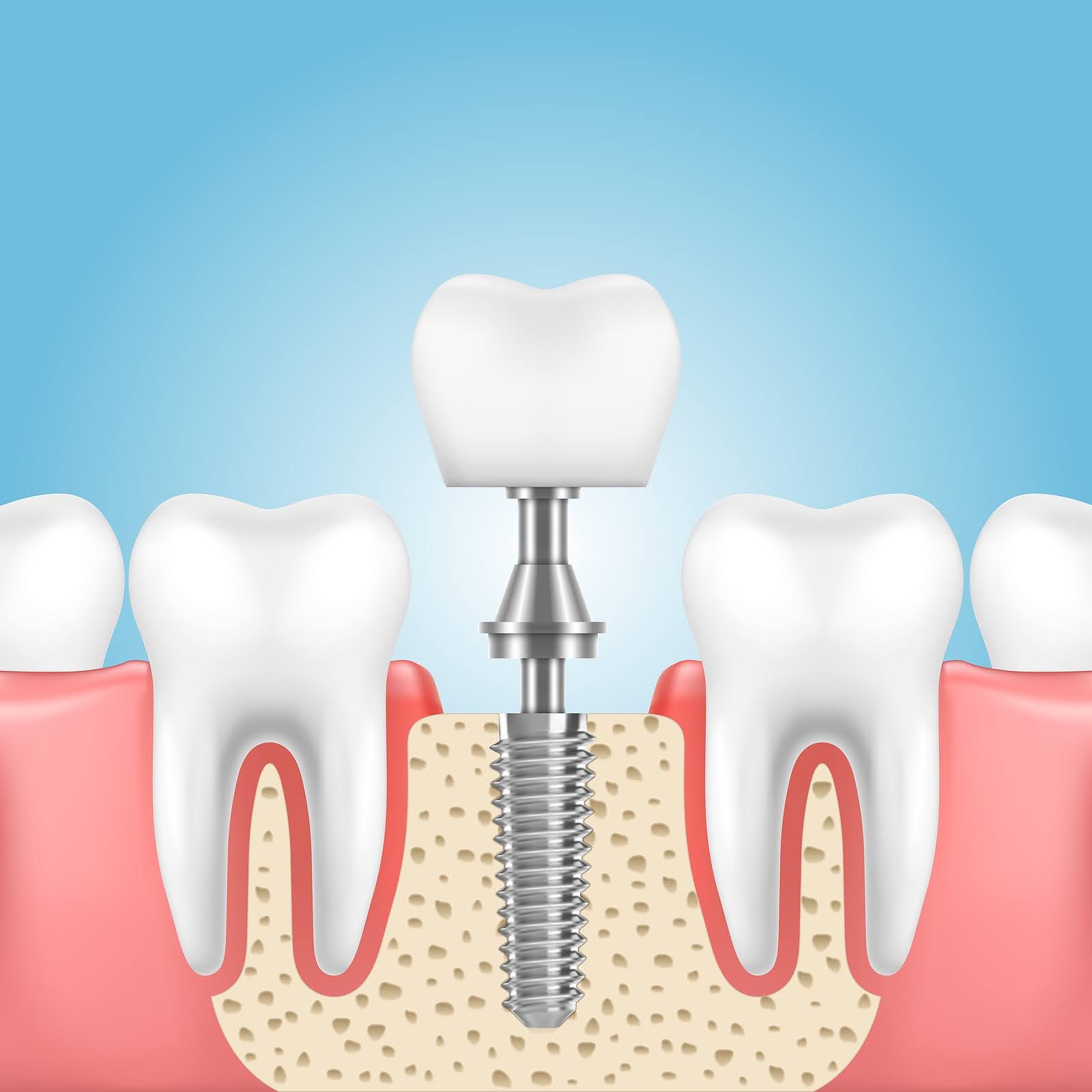 How Long Is Dental Implants Healing Time? Orthodental Inc.
